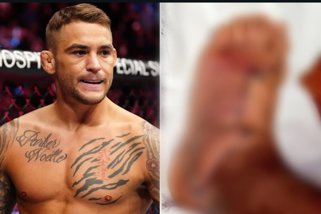 Dustin Poirier Suffers A Bad Case Of Staph [GRAPHIC] - BJJ World