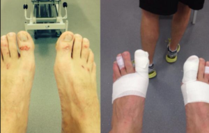 Mat Burn In BJJ: What It Is, How To Prevent It, And How To Treat It ...